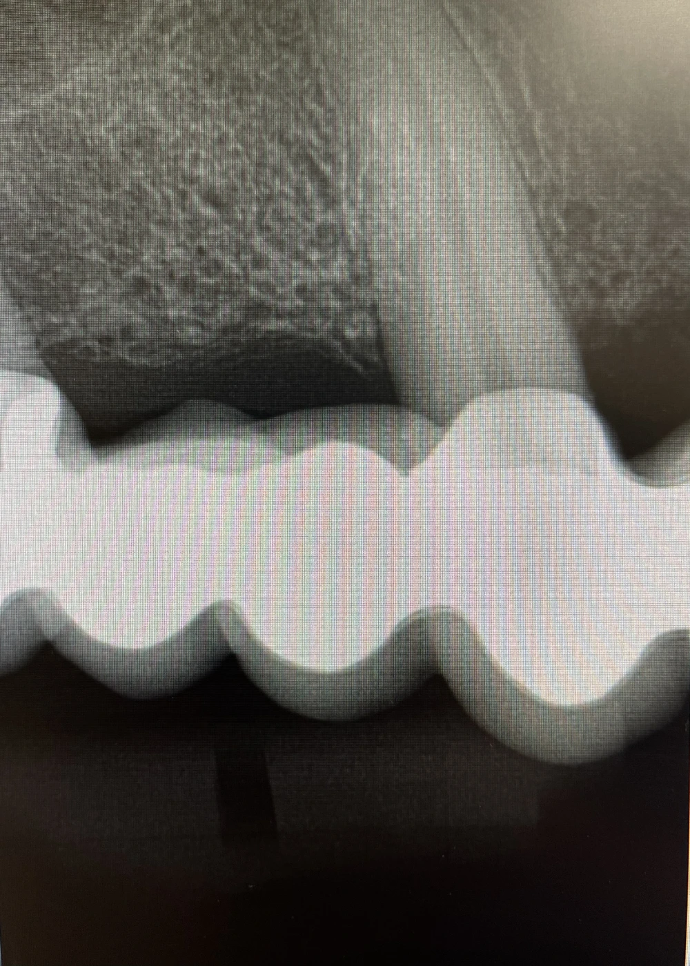 Dental Article - Some Dental Implant Case Studies - Dr Ahmed Farid